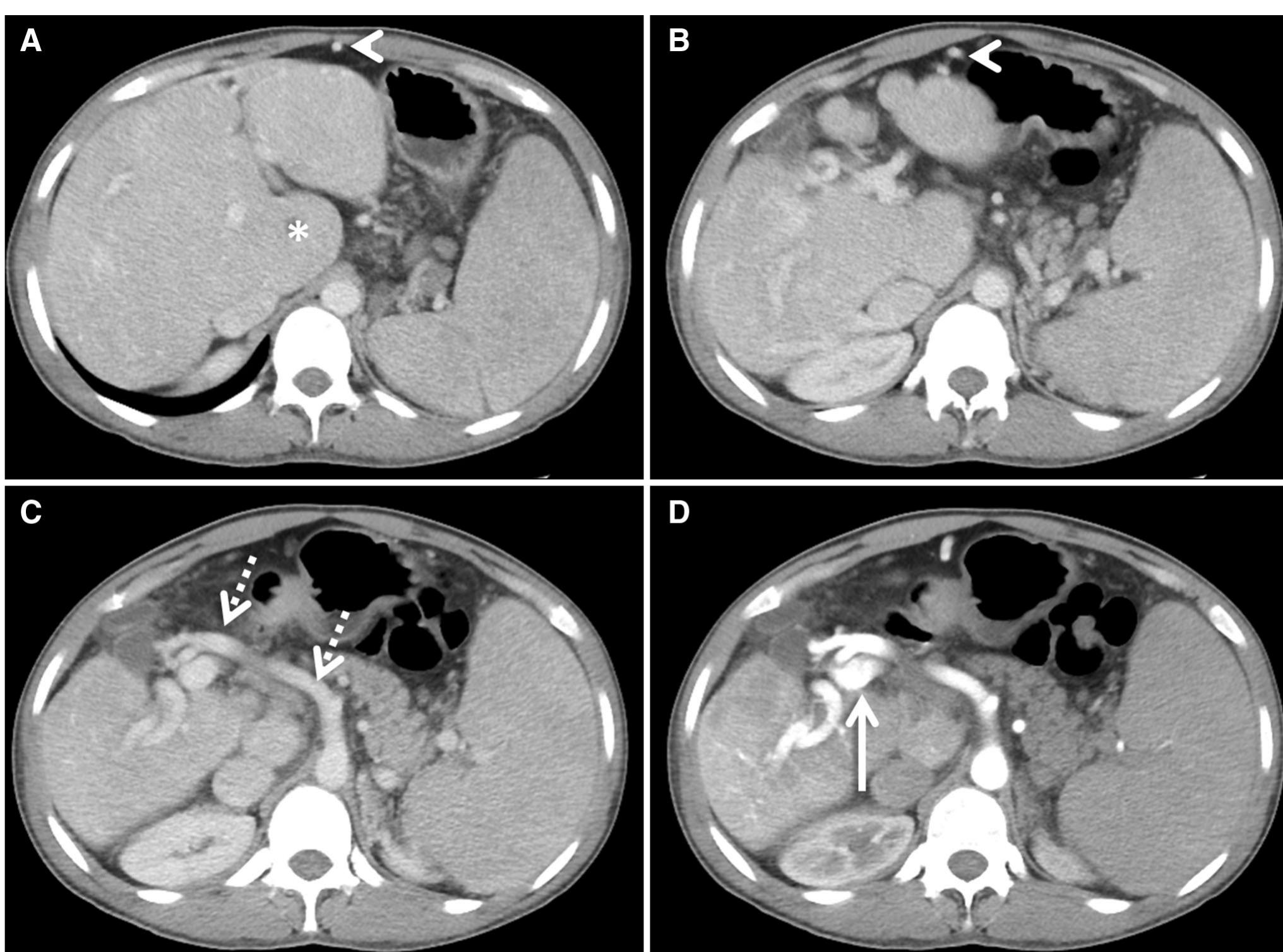 A-c axial portal venous phase ct images of a 24-year-old