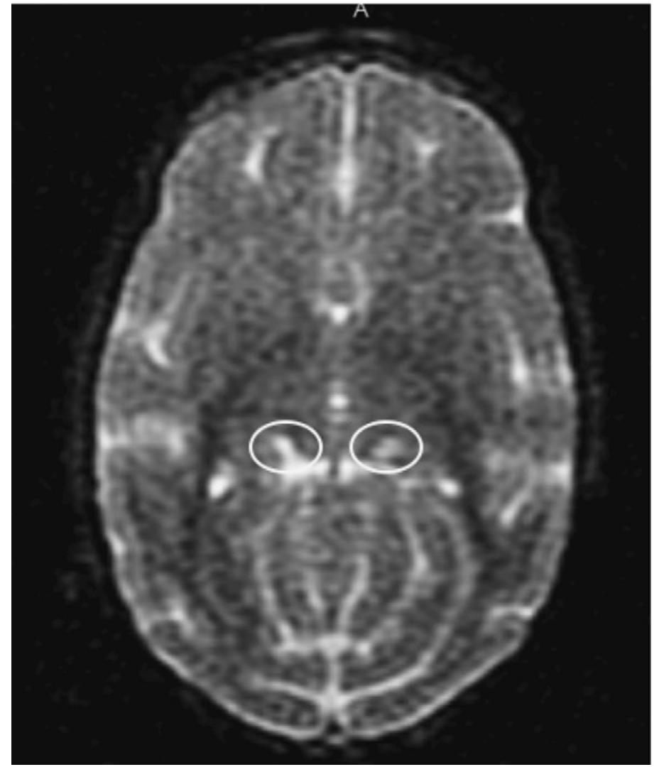Sc lesions in mri. axial mri-scan showing the hypersignal