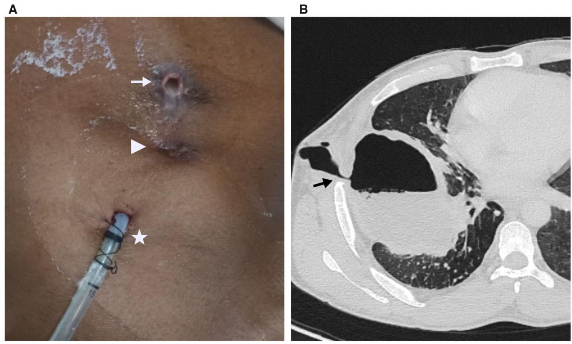 Figure 1 - from Pleuro-cutaneous fistula: a rare
