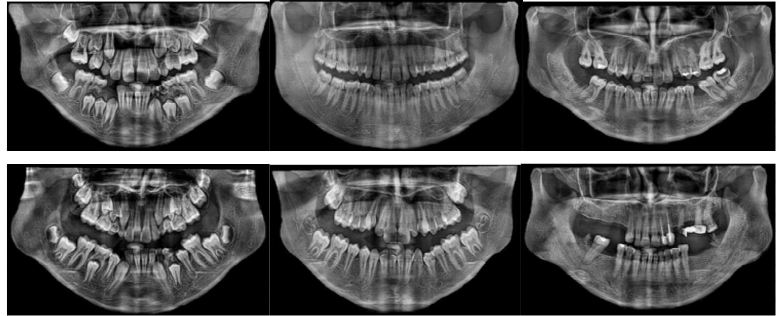 Sample panoramic dental radiographs of six persons at 0°