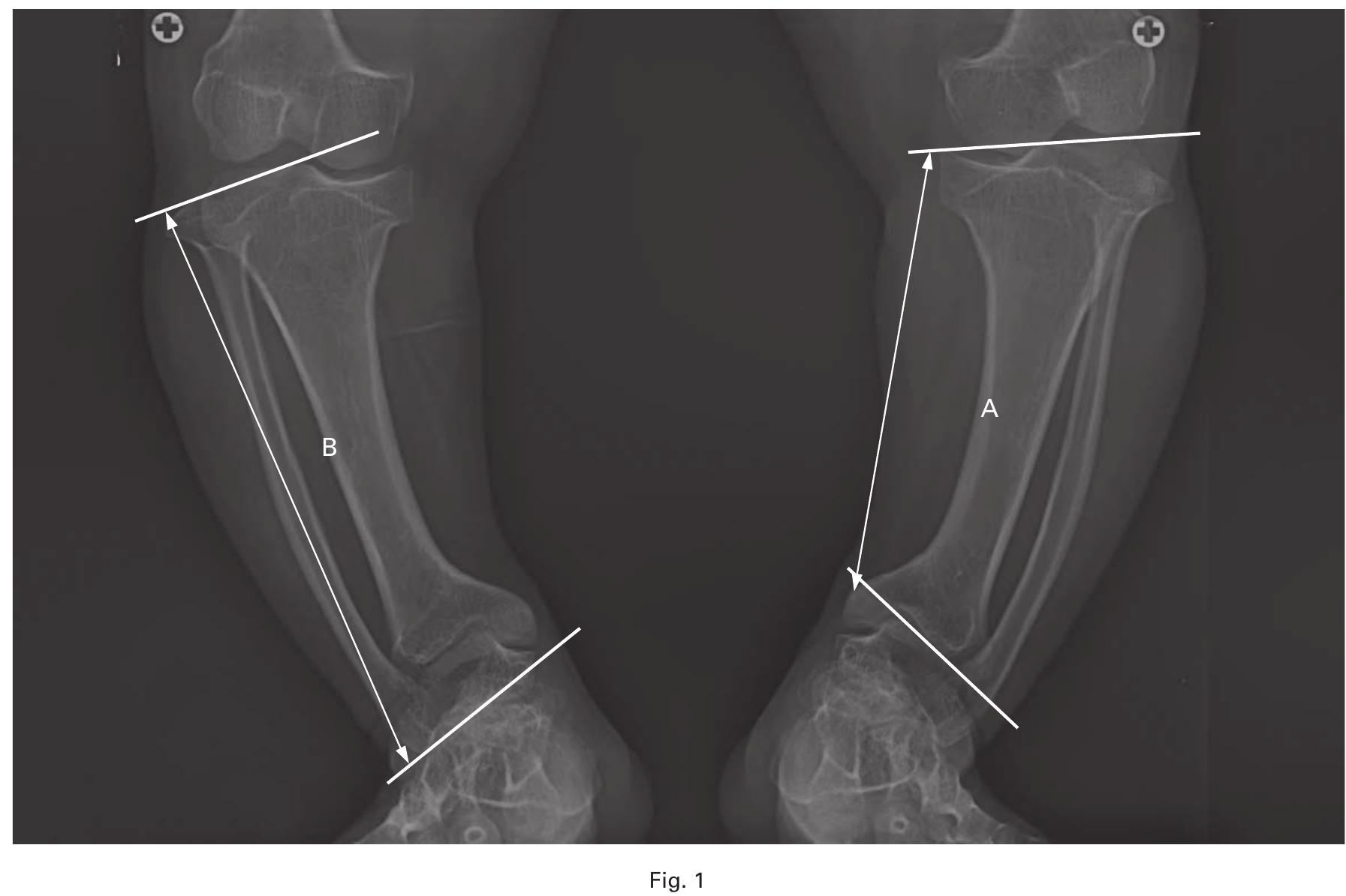 Radiograph showing the method of measuring the lengths of