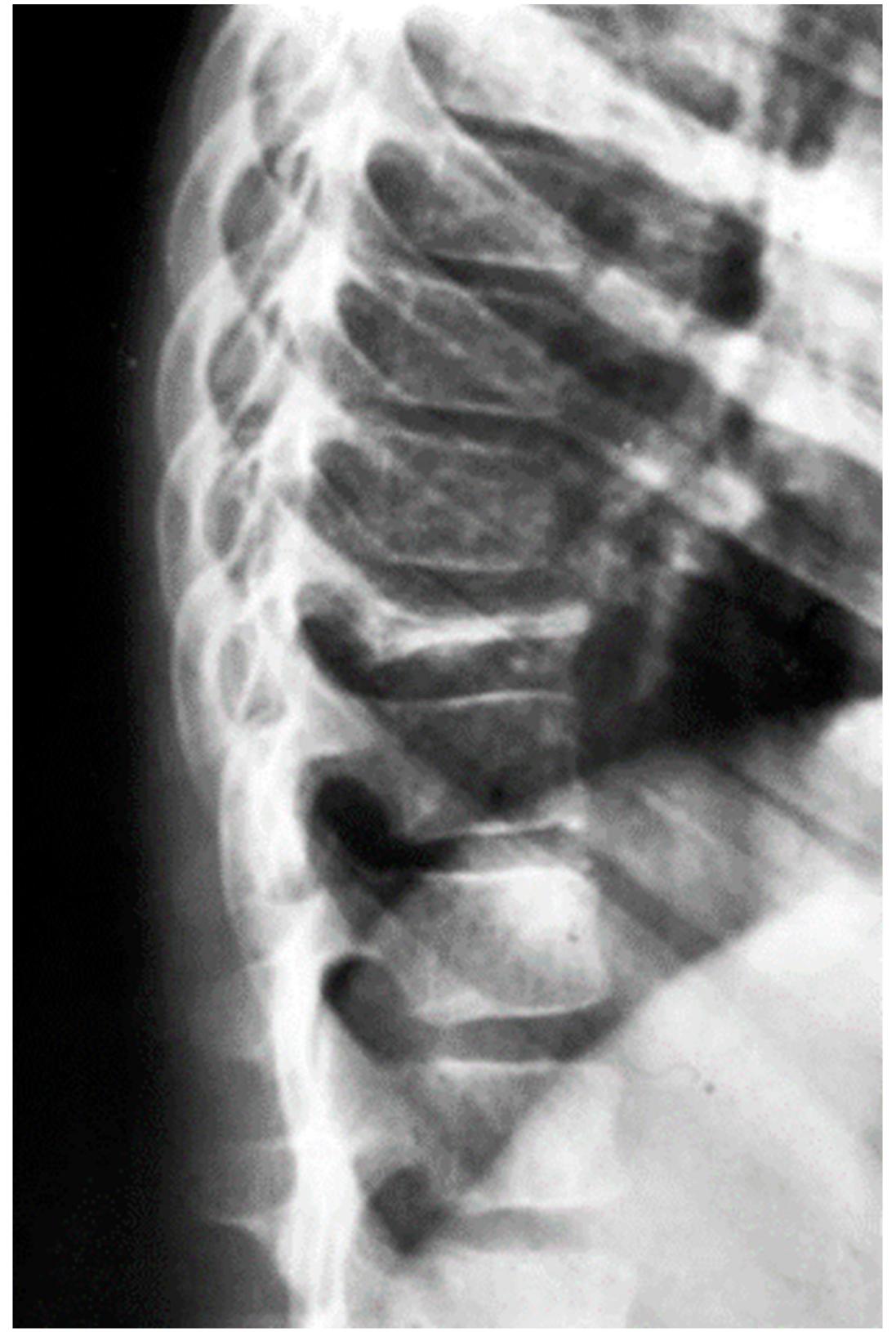 Lateral thoracic spine radiographs of a 7-year-old boy