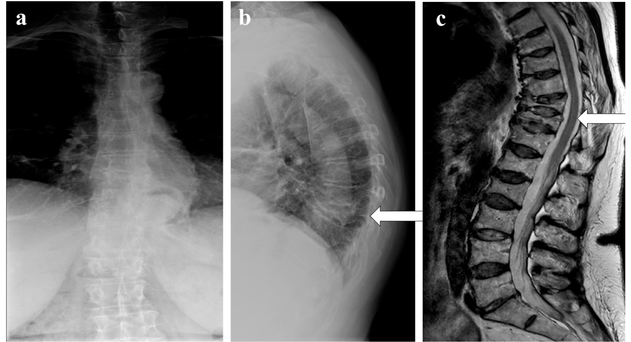 Osteoporosis and fragility fractures in an 85-year-old