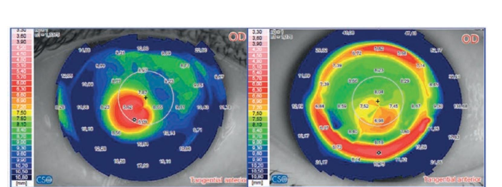 Ig. 1| tangential anterior curvature map (sirius, cso)