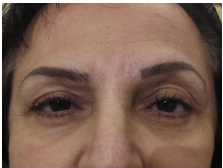 Eyelid-globe vector assessment. in the lateral view, a line