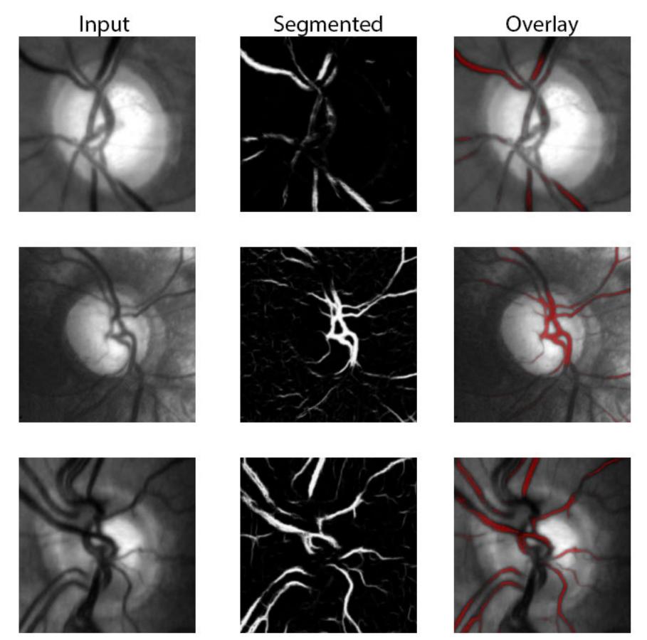 Figure 12 - Deep Learning-Based Glaucoma Detection With Figure 12 - Deep Learning-Based Glaucoma Detection With