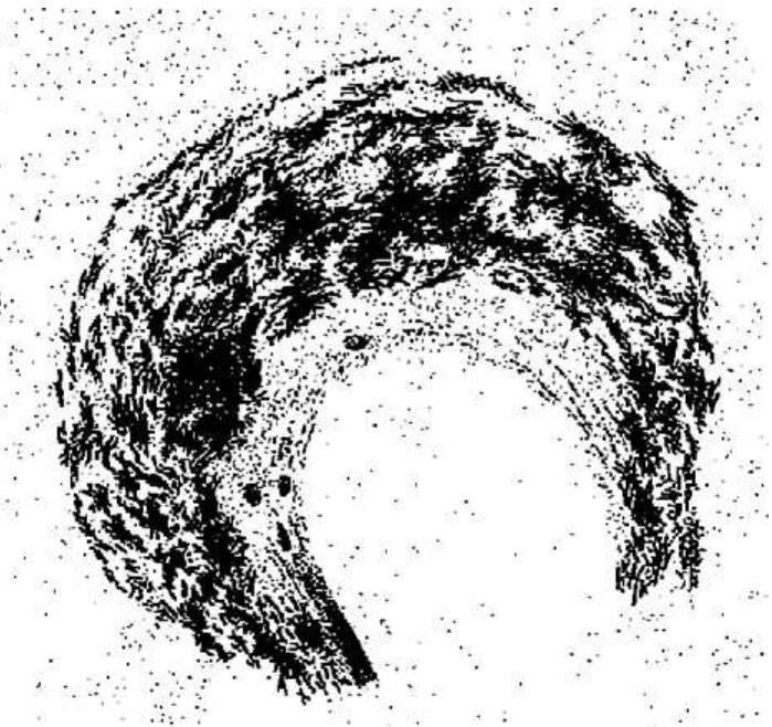 Koch’s drawing of tubercle bacilli in the arterial wall of a