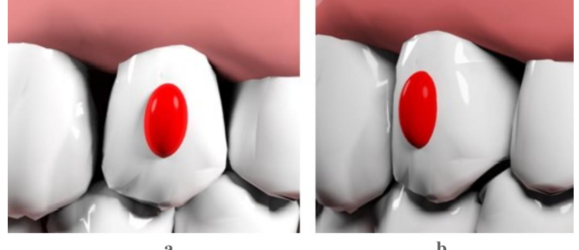 (PDF) Importance of Attachments in Treatment with Clear Aligners: A ...