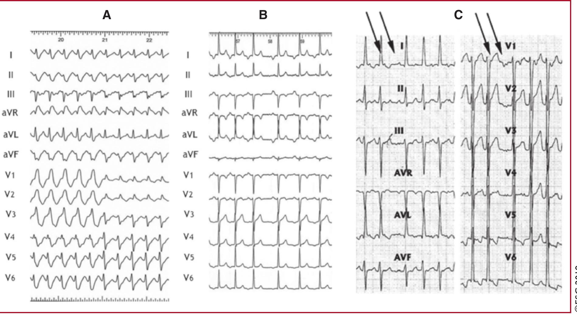 Focal atrial tachycardia. (a) focal atrial tachycardia