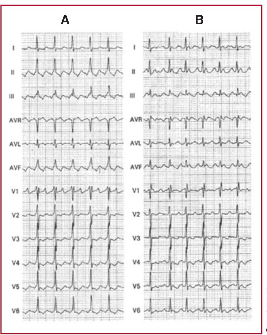 Counter-clockwise (a) and clockwise (b) atrial flutter with
