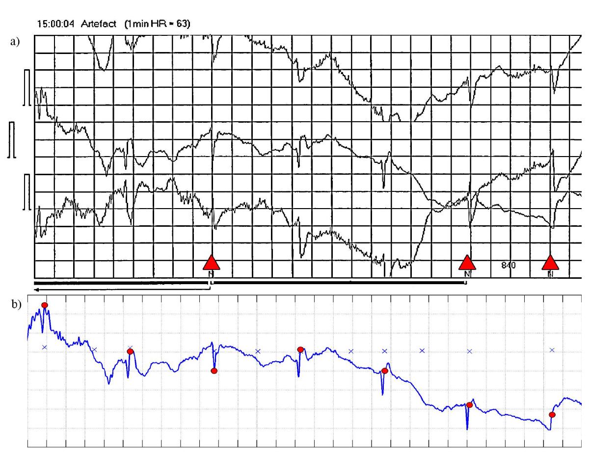 Qrs Complex Detection In Noisy Holter Ecg Based On Wavelet