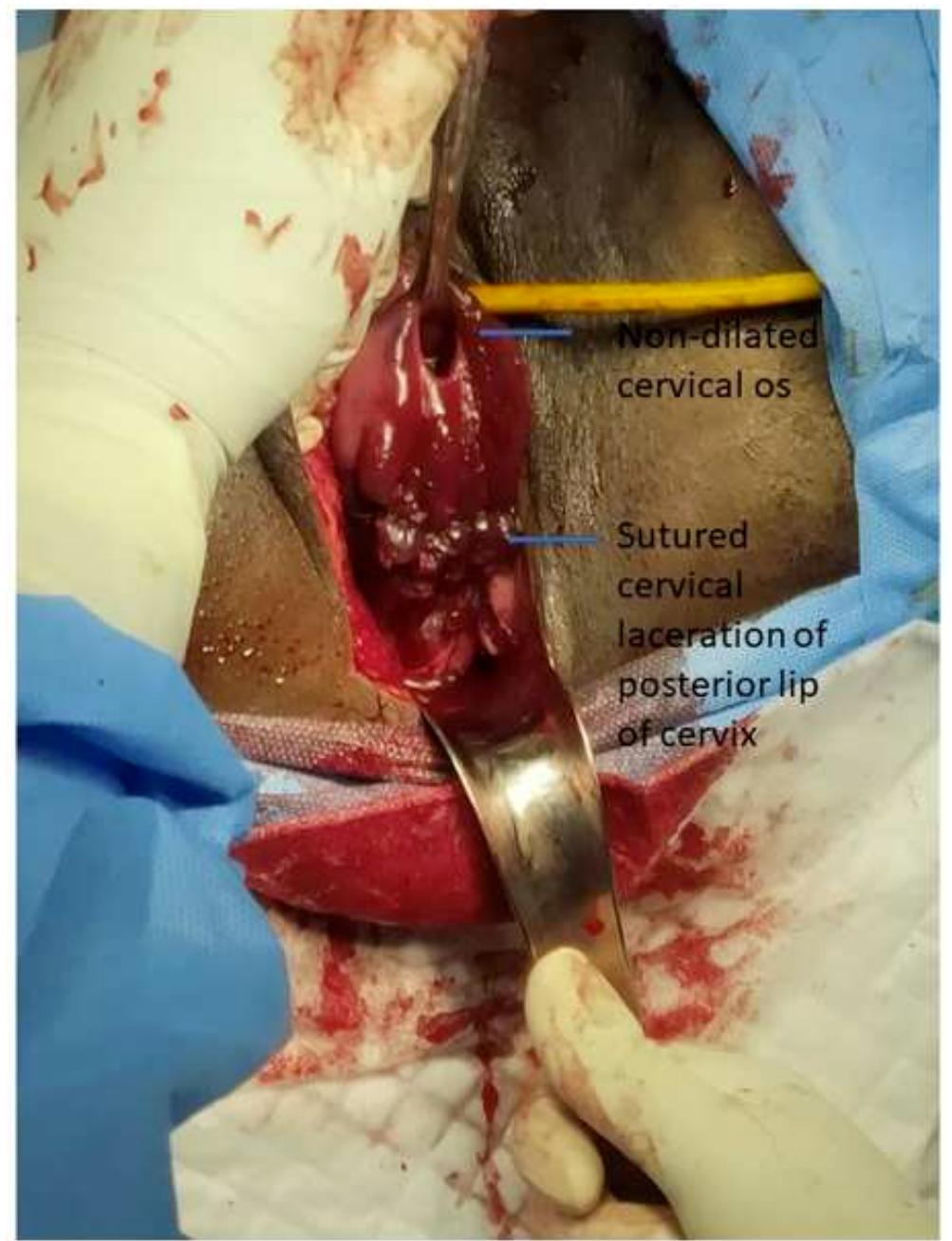 Sutured posterior cervical tear