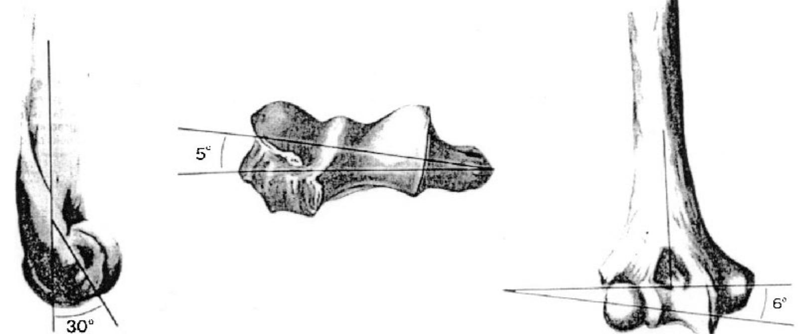 A, lateral view shows 30° anterior rotation of the distal