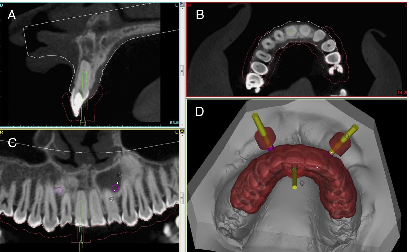 A cbct image of the right maxillary central incisor with