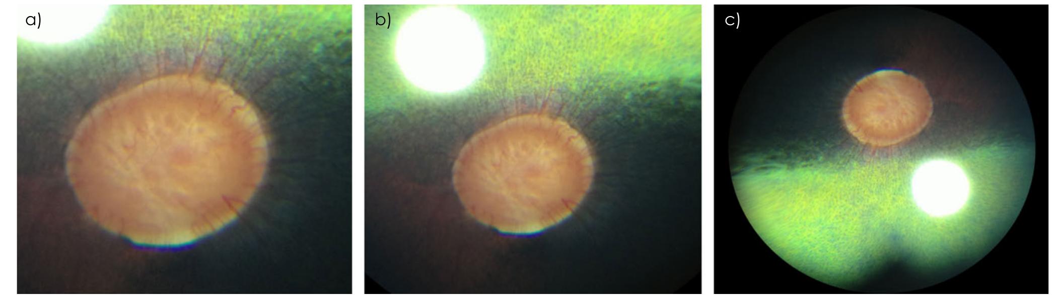 These photos illustrate the ophthalmoscopy view with direct