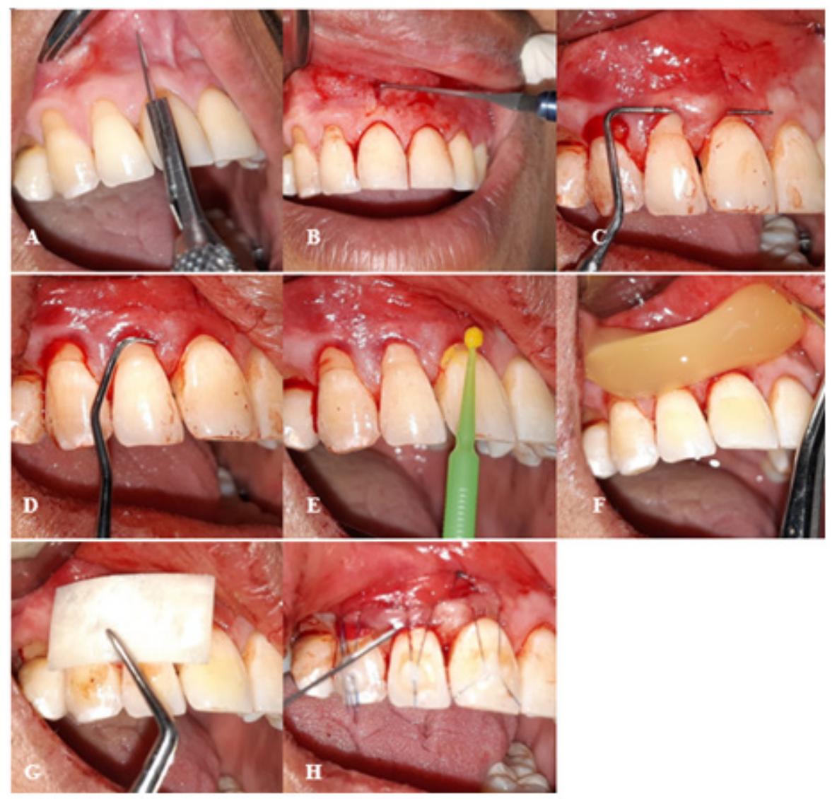 (a) vertical incision using blade no.15c; (b) periosteal
