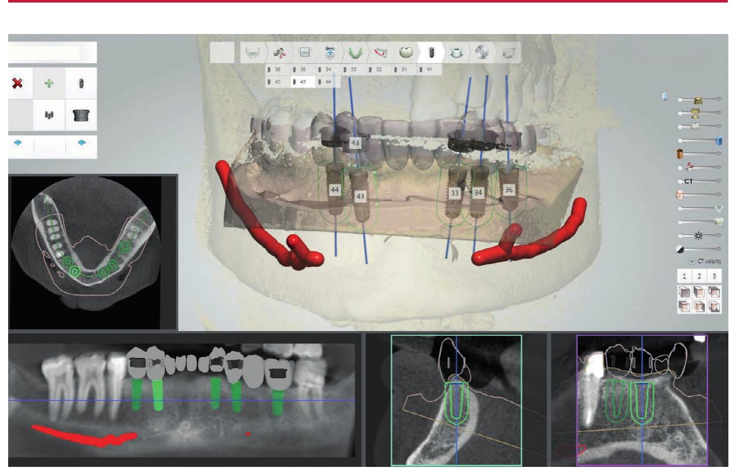 A) correlation of the dicom data with the stl data of the