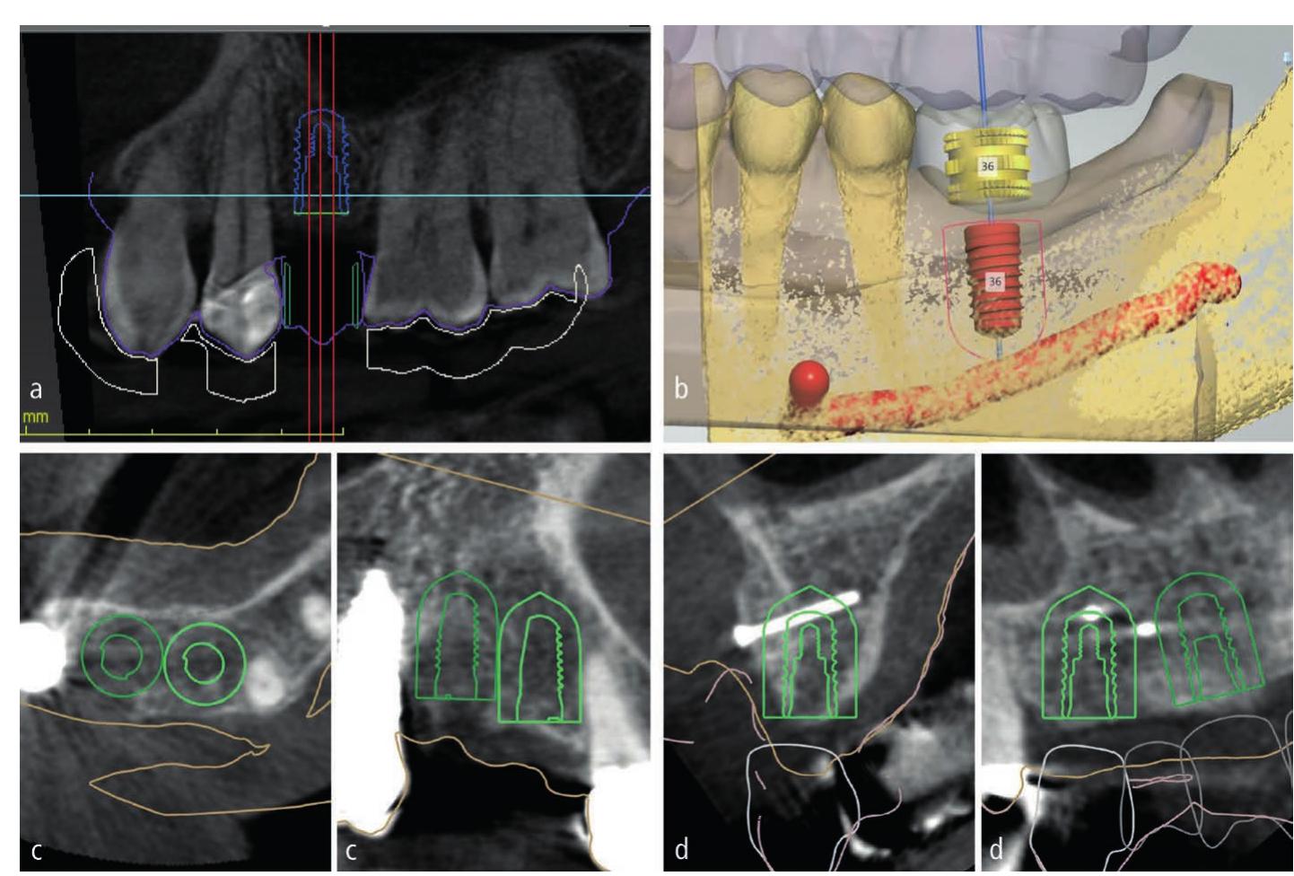 A) virtual planning of the projected dental prosthesis via