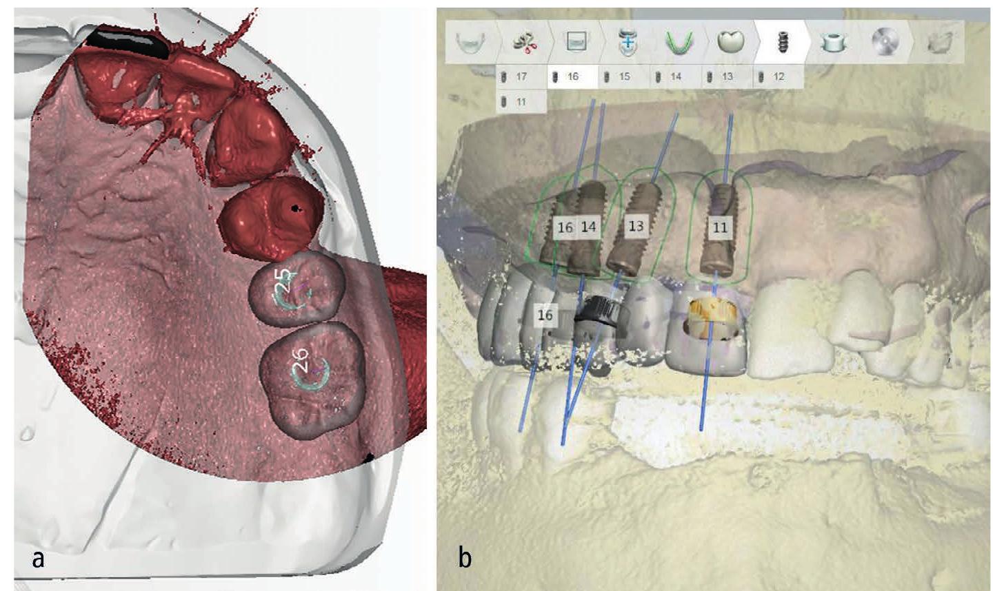Figure 4 - Digital implant planning and guided implant