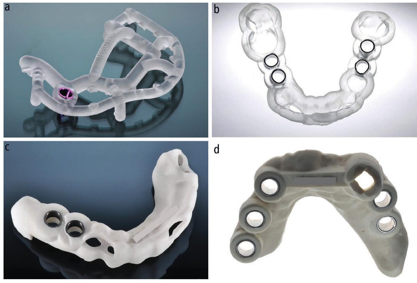Figure 7 - Digital implant planning and guided implant