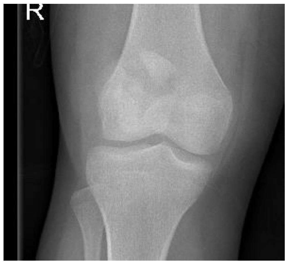 By the end of 2 weeks, sutures were removed, and 90 degrees