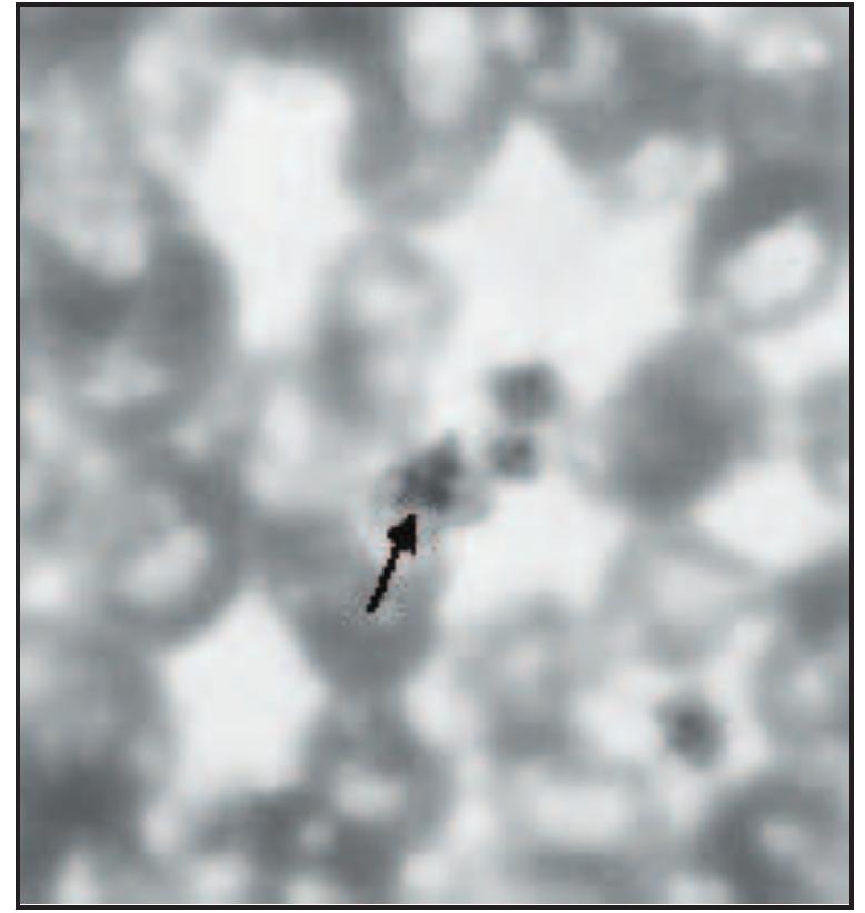 Platelet inclusion bodies in stained diff- quik blood smear