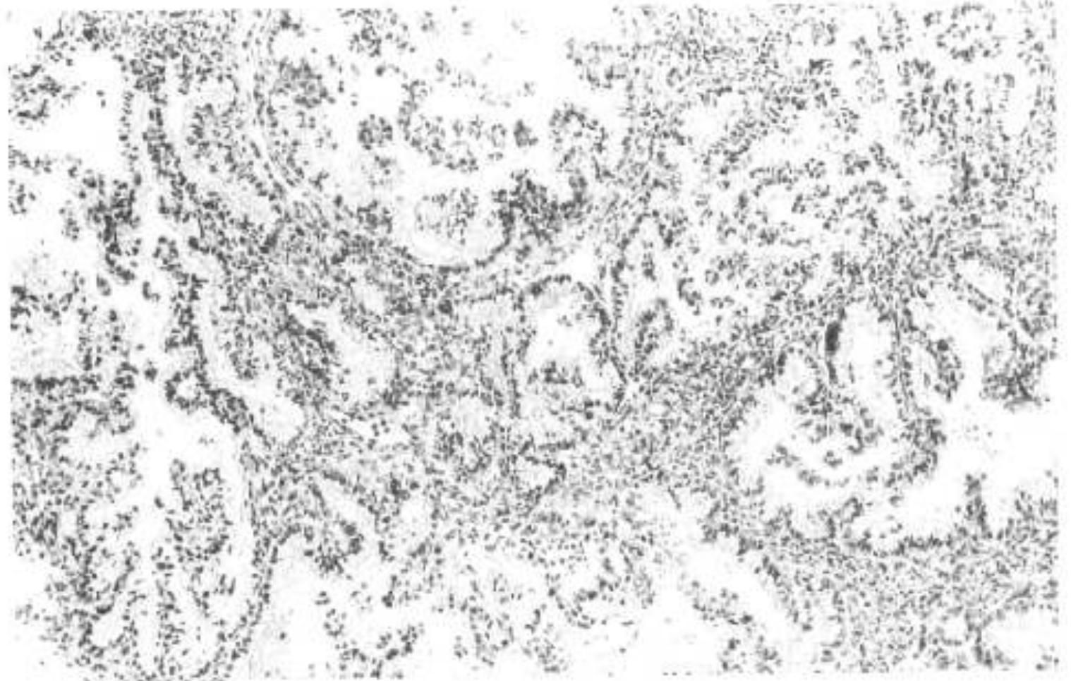 Invasive endocervical adenocarcinoma. papillations and