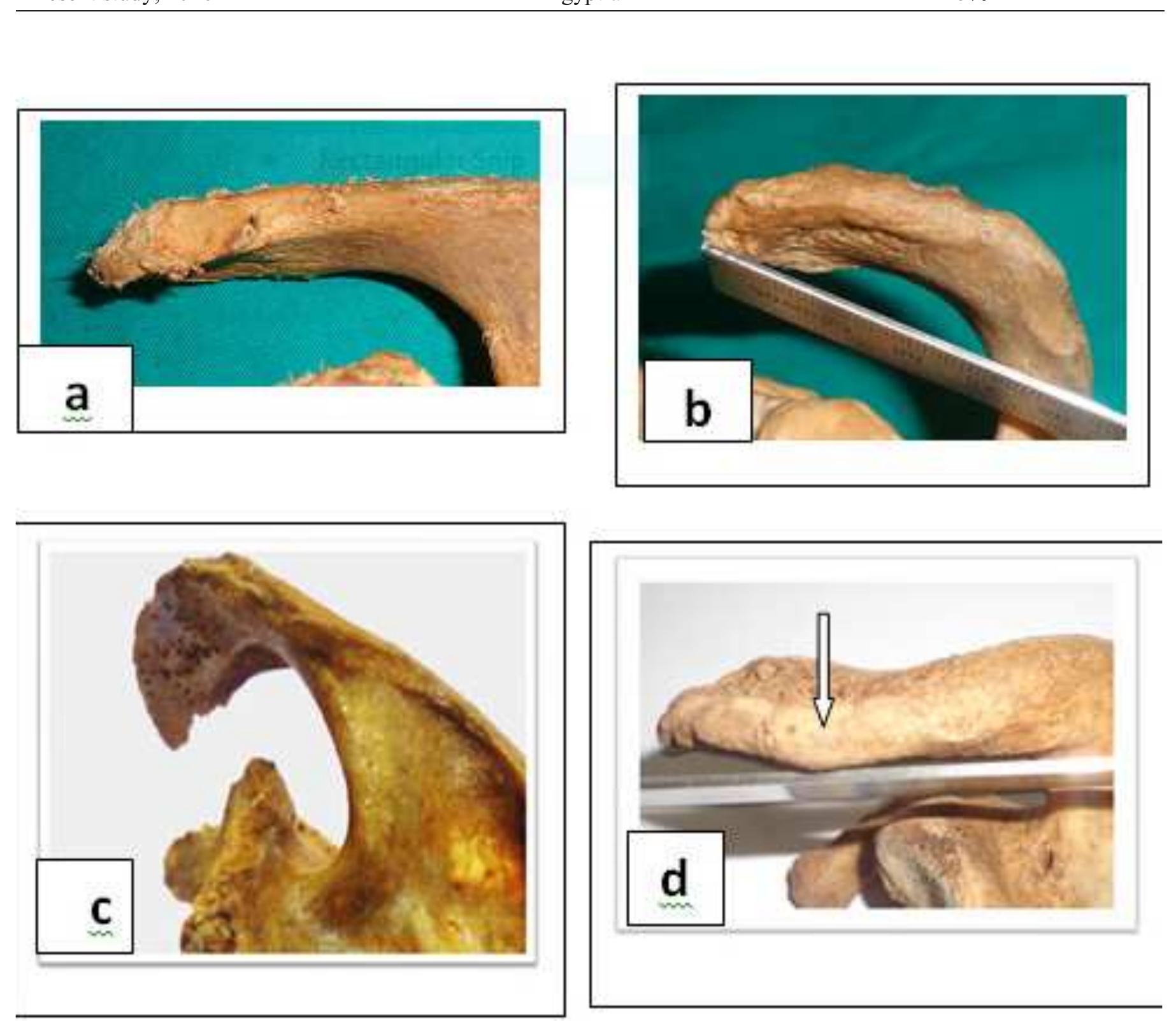 Figure 3 - from Anatomical Variations of the Scapula in