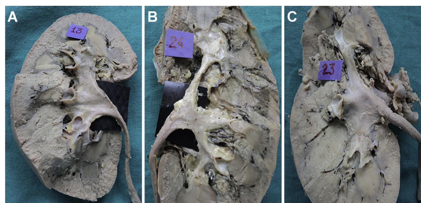 Figure 4 - Revisiting the morphology of pelvicalyceal system