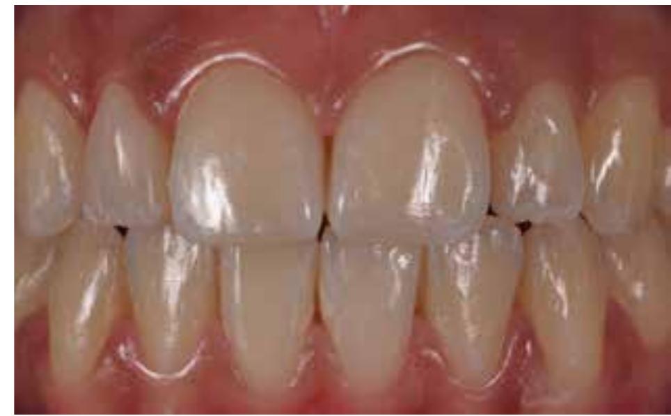 B_ final dental gingival photo of anterior teeth in maximum