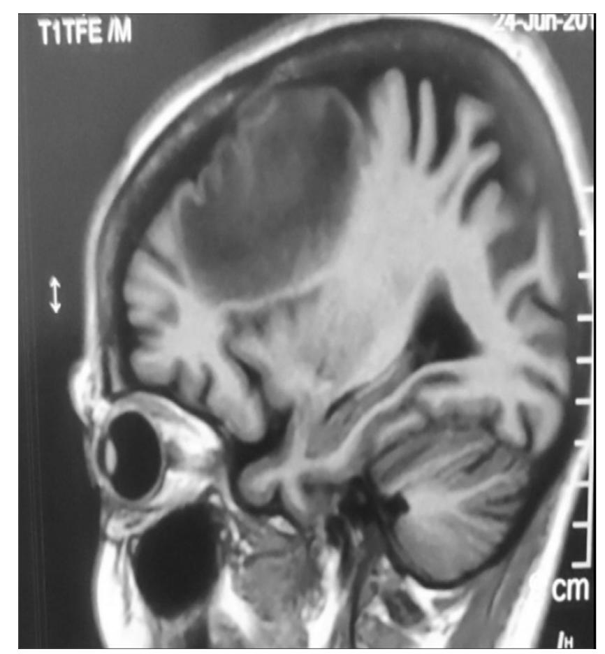 Case-6, left temporo-parietal lobe sol fractions over 6