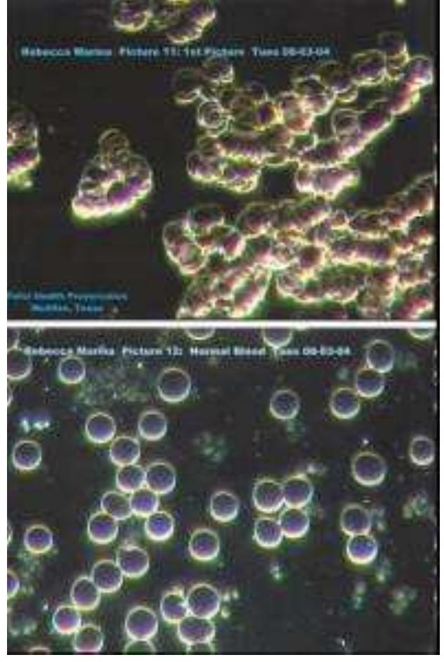 2. blood cells when healthy: red blood cells become normal.
