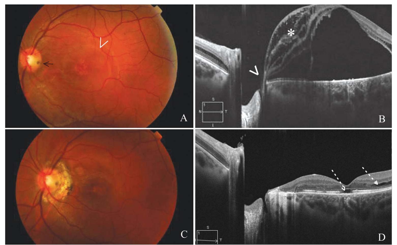 Invaginated pit structure for all three nasal disk pits in