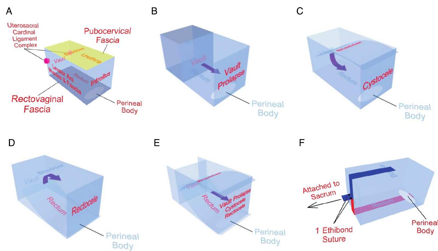 A. normal support anatomy of the vagina. b. vault prolapse.