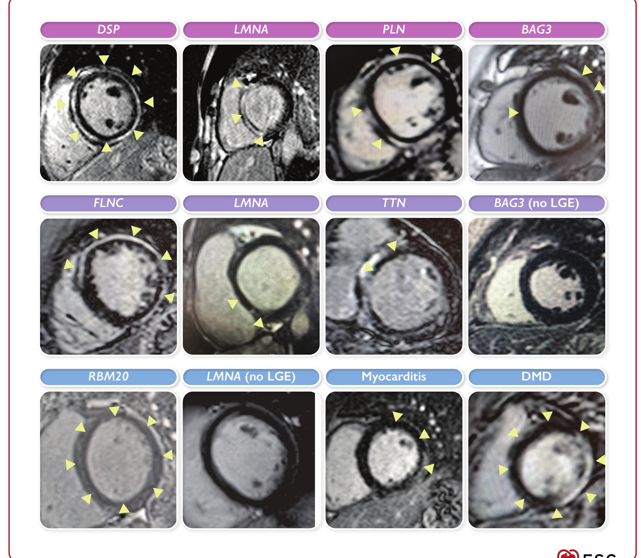 Examples of non-dilated left ventricular cardiomyopathy