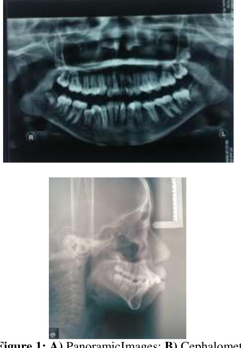 Diagnosis of class ii skeletal malocclusion and angle ii