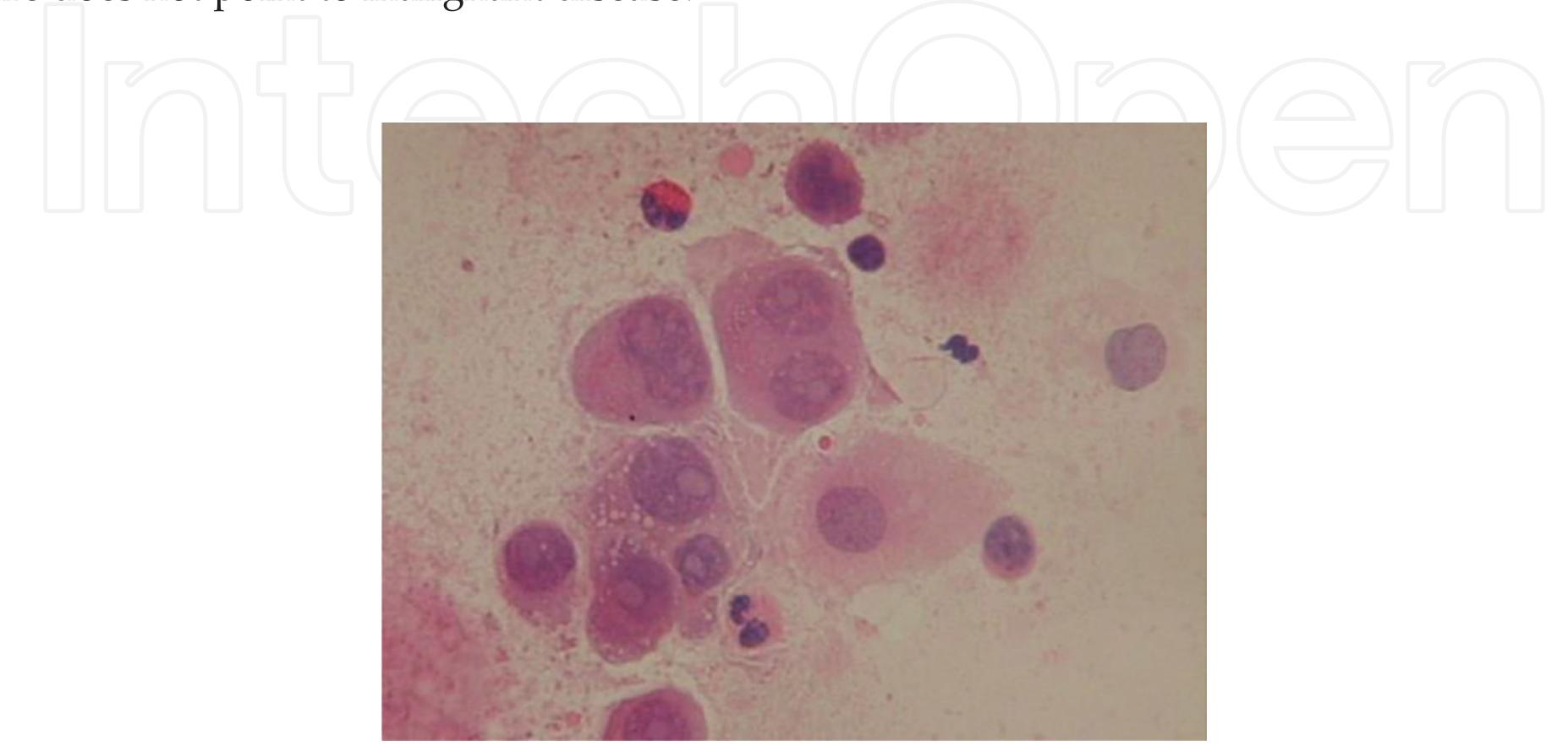 Atypical giant cells in pleural effusion. malignant cells