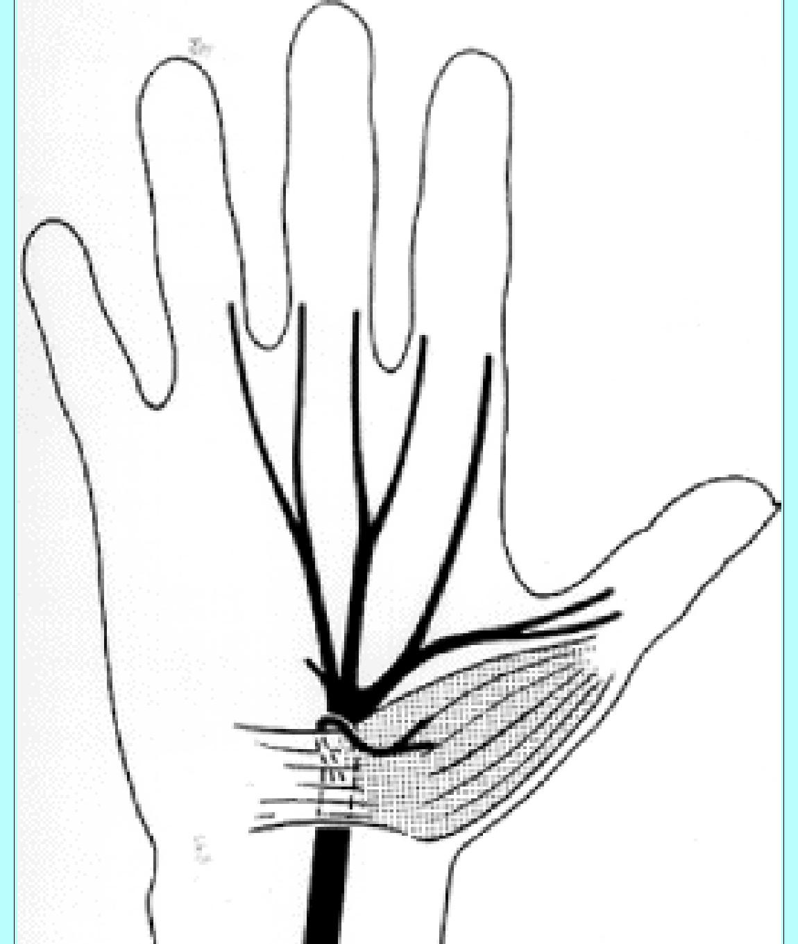 Illustration depicting the treacherous ulnar origin of the