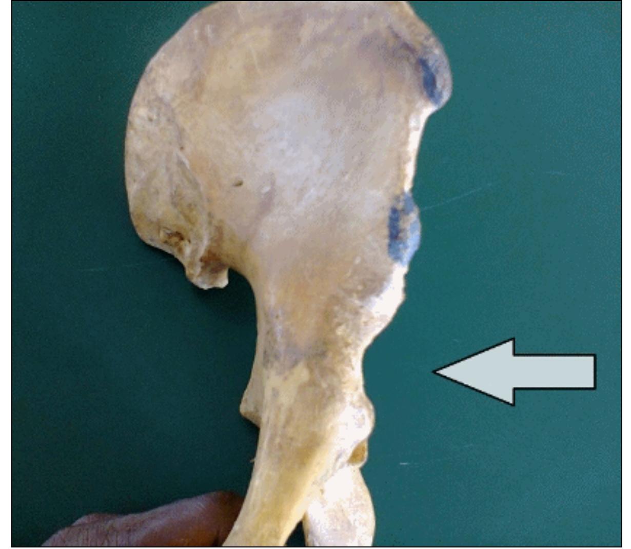Curved shape of anterior acetabular ridge table 3: