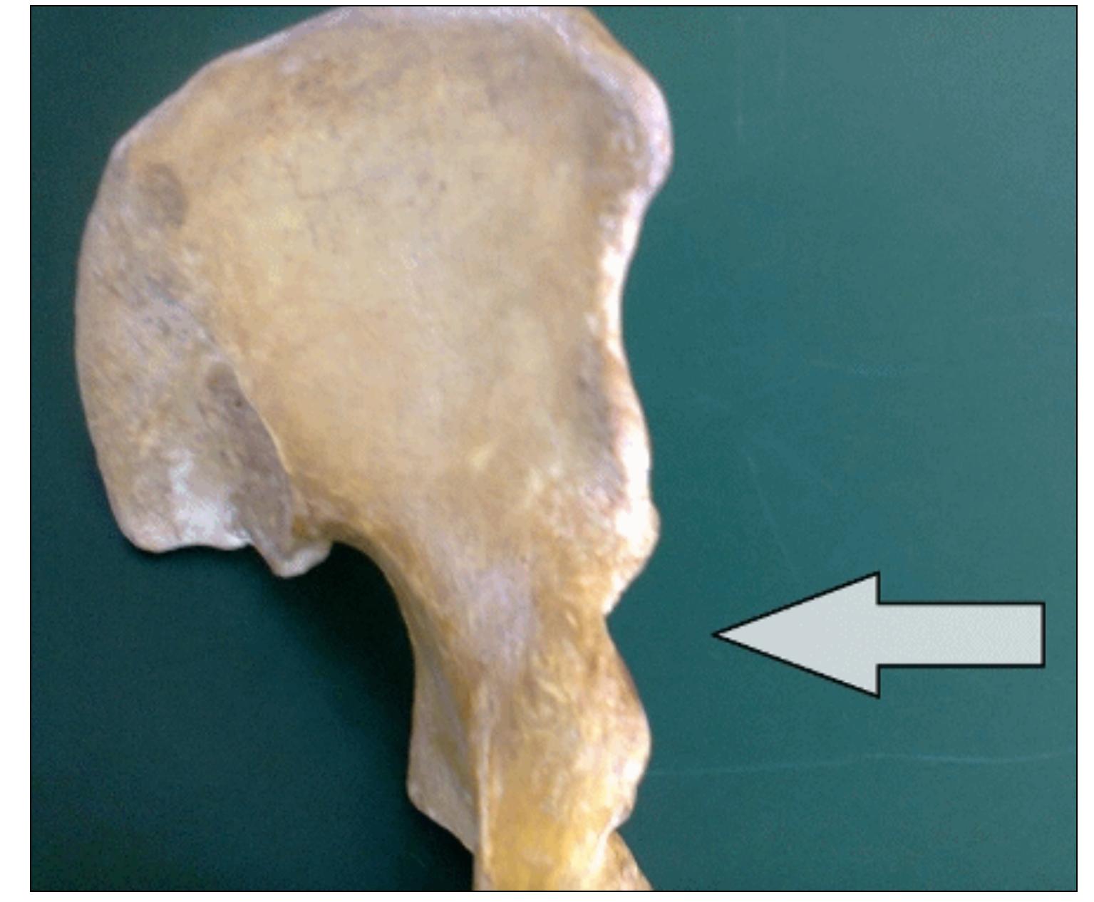 Angular shape of anterior acetabular ridge. in the present