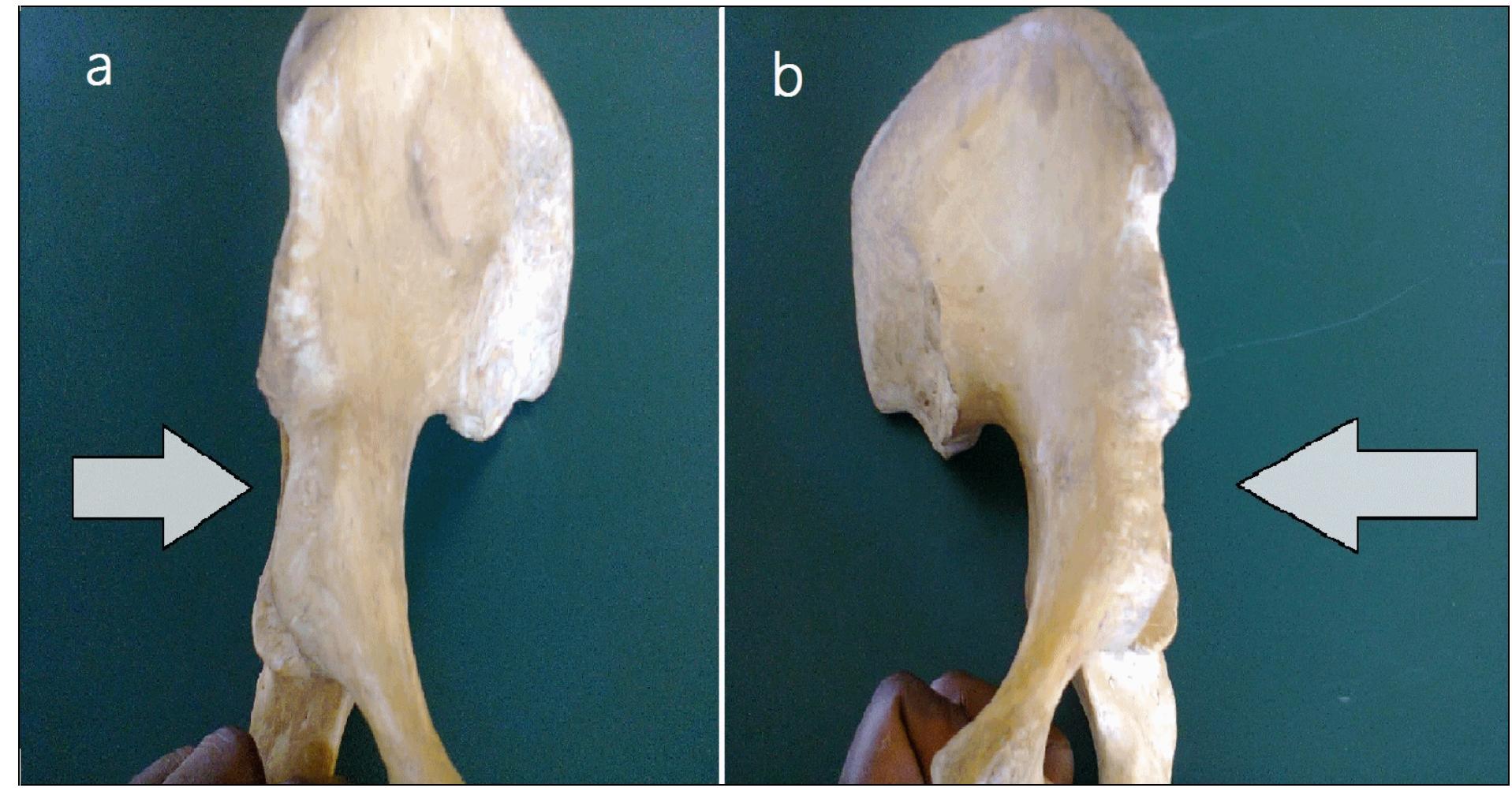 A. irregular shape of anterior acetabular ridge, b. straight