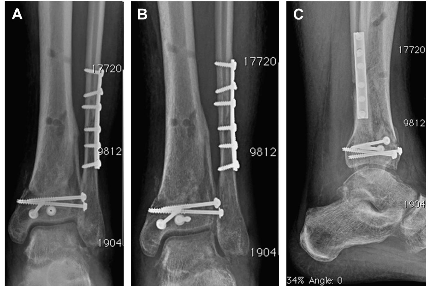 Ap (a), mortise (b), and lateral view (c) following circular