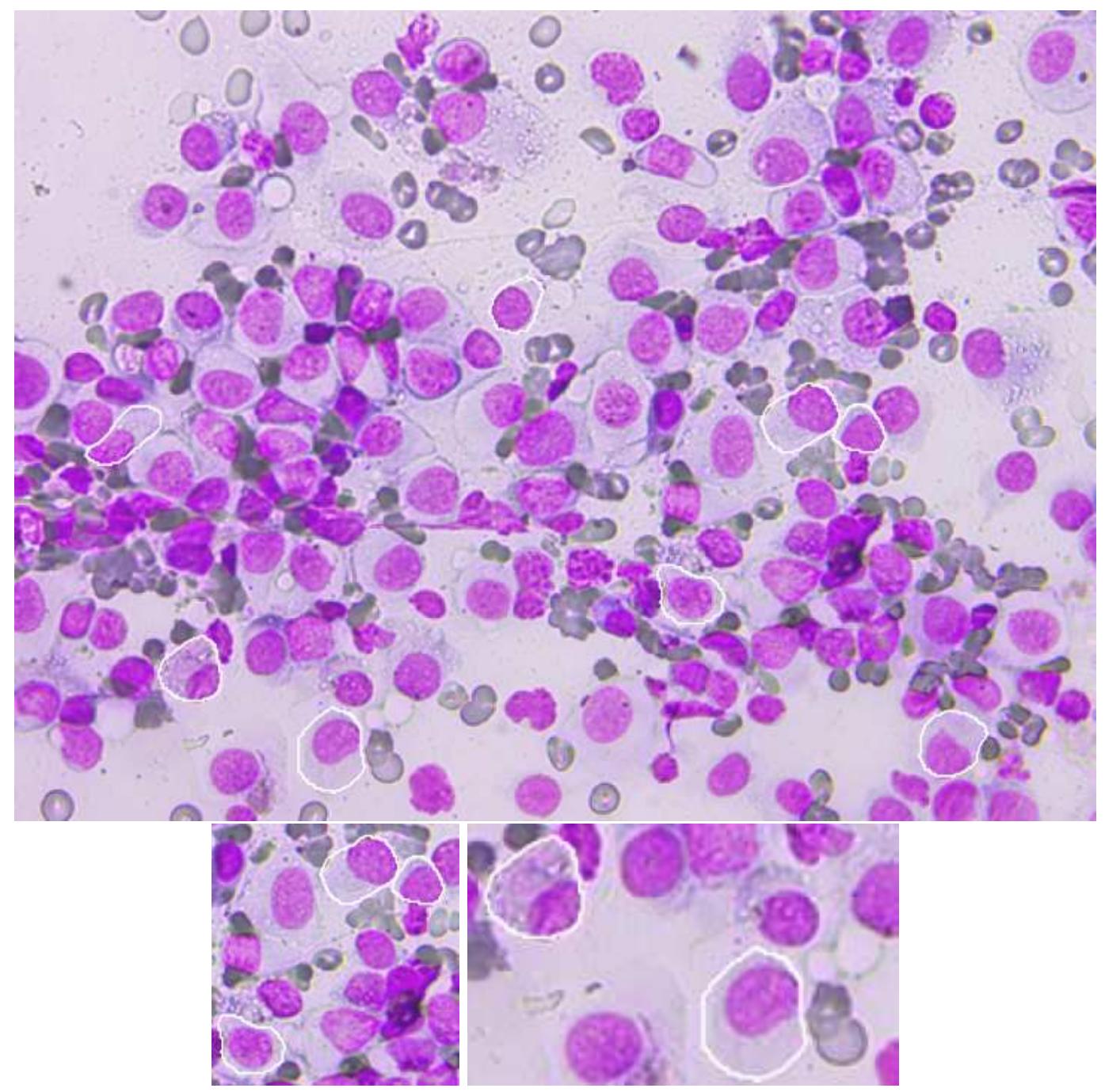 Undetected histiocytoma cell (surrounded with white