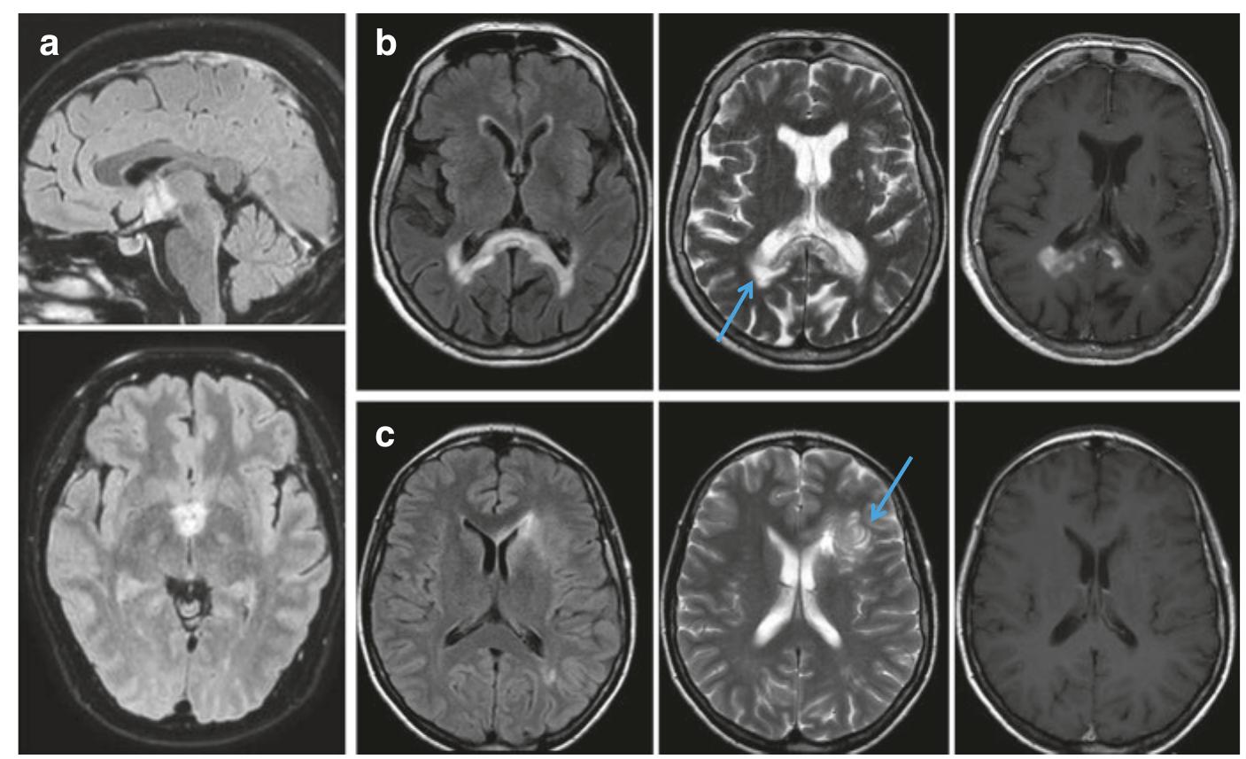 2 brain lesions in nmosd. panel (a) shows a diencephalic