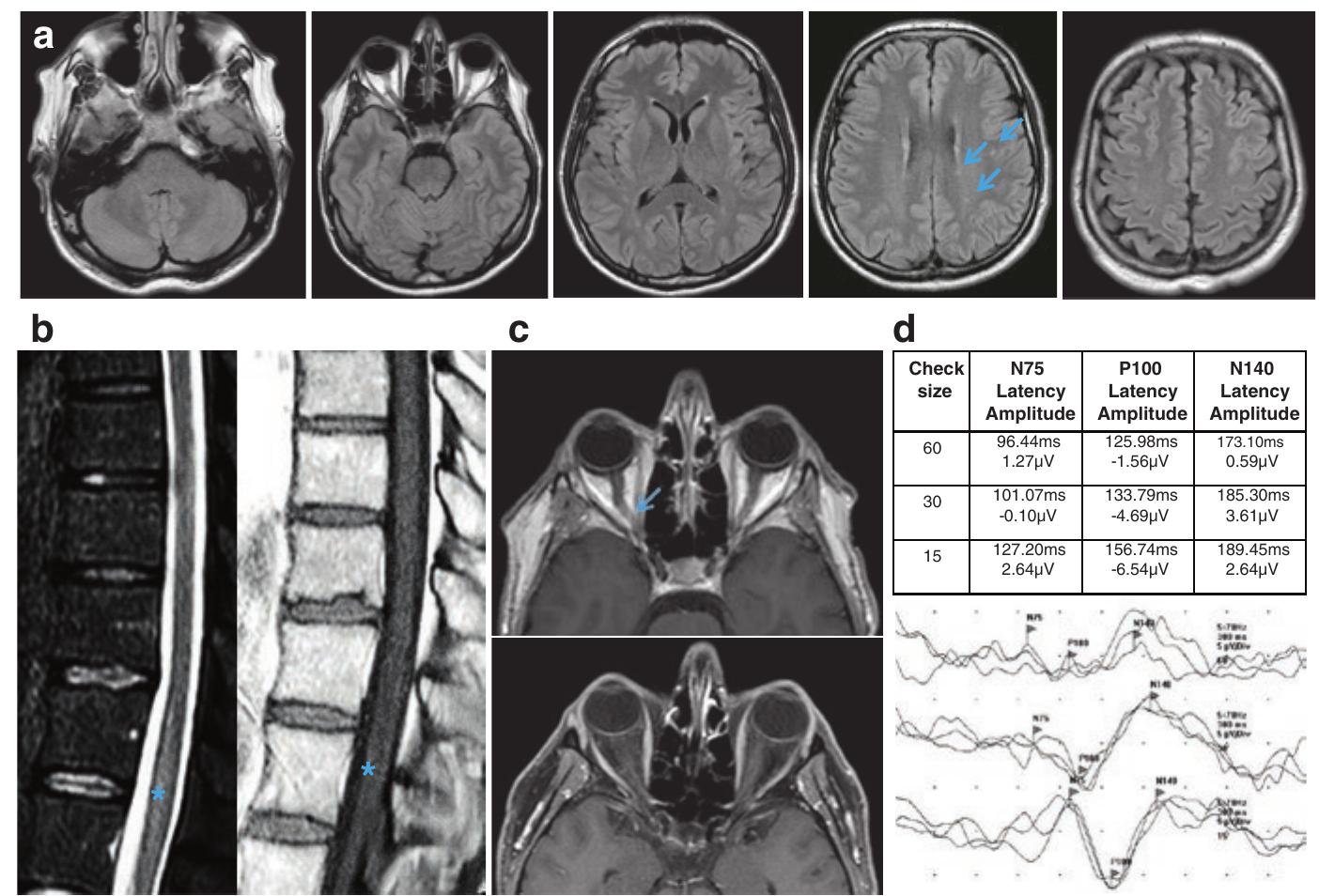 2 brain, spinal cord, and optic nerve findings in an anti-