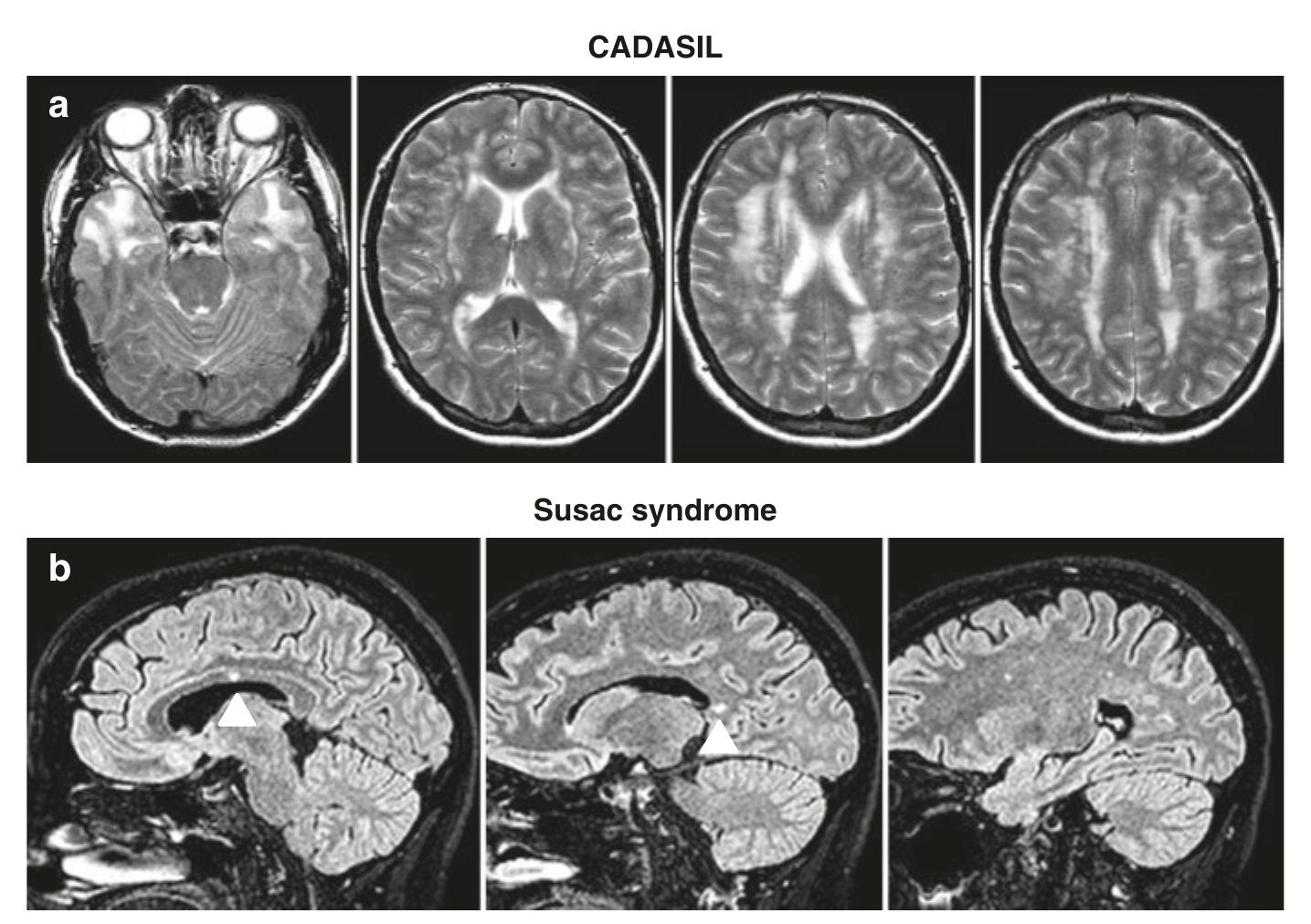 3 differential diagnoses of primary angiitis of the central