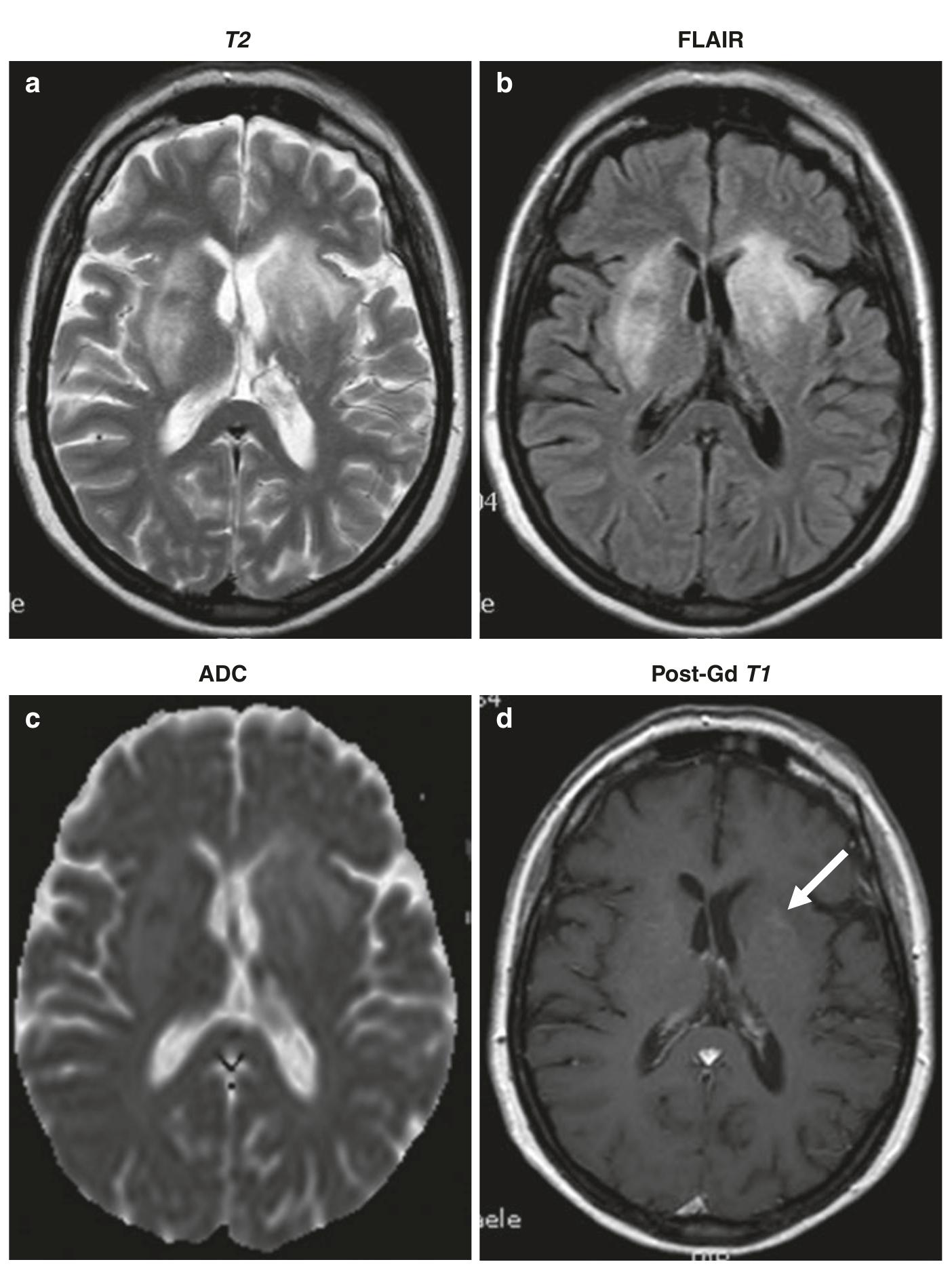 4 Neuropsychiatric Systemic Lupus Erythematosus Brain Mri