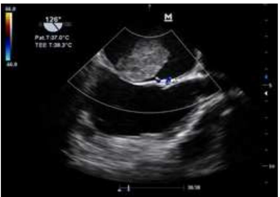 The dual atrial sectional view in transesophageal