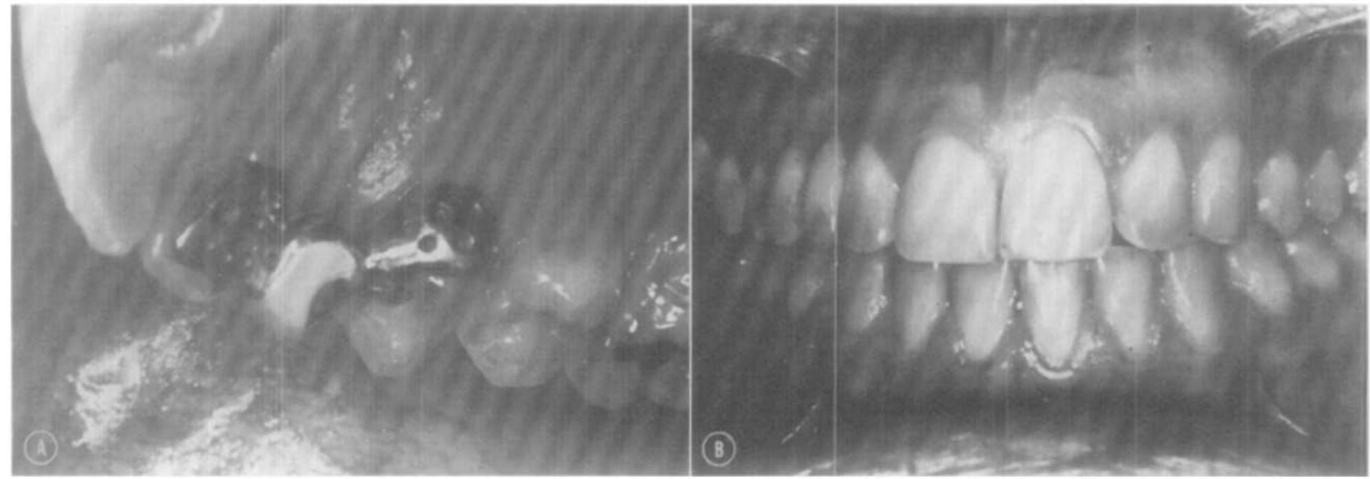A, perforated retainers replacing maxillary right canine