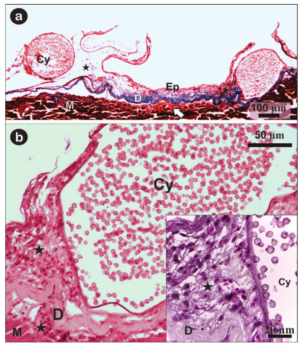 Cyst within the dermis extending to the epidermis as it
